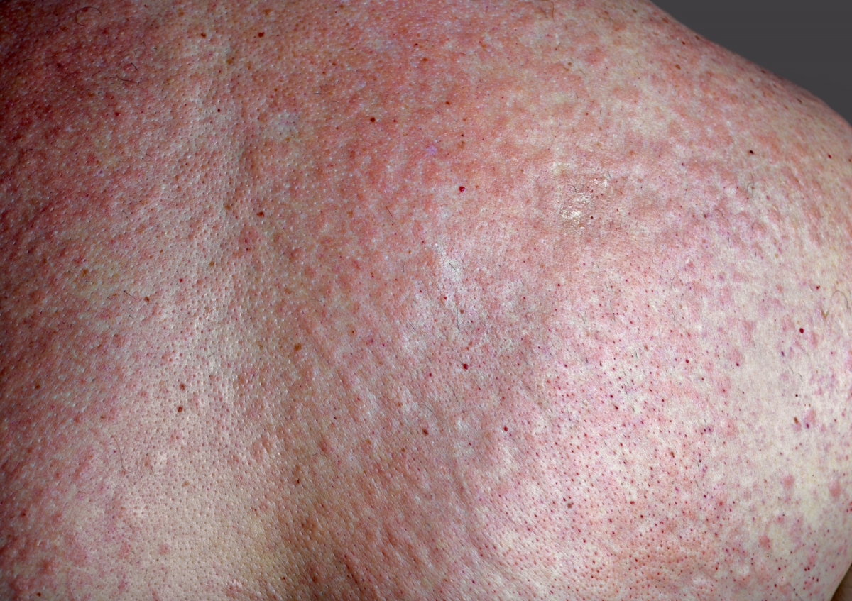 All You Need To Know About Hives Causes Symptoms Treatment Walkin All You Need To Know About Hives Causes Symptoms Treatment Walkin